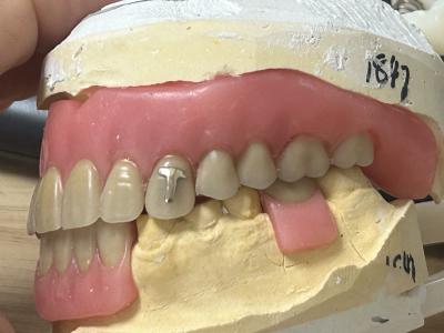 China Customized Gold Teeth with Removable Denture for sale