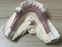 China Lightweight Metal-Free Biocompatible PEEK Partial Denture Framework for Removable Partial Dentures for sale