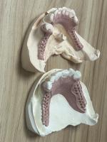China Lightweight Metal-Free Biocompatible PEEK Partial Denture Framework for Removable Partial Dentures for sale