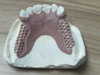 China Lightweight Metal-Free Biocompatible PEEK Partial Denture Framework for Removable Partial Dentures for sale