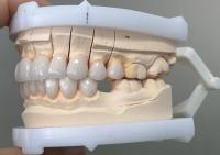 China High Strength All-Zirconia Crowns and Veneers with Natural Tooth-Like Appearance via CAD/CAM Precision Manufacturing for sale