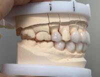 China High Strength All-Zirconia Crowns and Veneers with Natural Tooth-Like Appearance via CAD/CAM Precision Manufacturing for sale