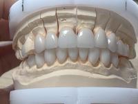 China High Strength All-Zirconia Crowns and Veneers with Natural Tooth-Like Appearance via CAD/CAM Precision Manufacturing for sale