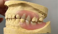 China Flexible Partial Denture with Custom-Made Digital Design and Tooth-Colored Gum-Colored Aesthetic for sale