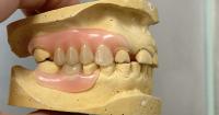 China Flexible Partial Denture with Custom-Made Digital Design and Tooth-Colored Gum-Colored Aesthetic for sale
