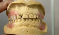 China Flexible Partial Denture with Custom-Made Digital Design and Tooth-Colored Gum-Colored Aesthetic for sale