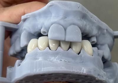 China Full Zirconia Dental Restoration with High Strength Natural Tooth-Like Appearance and Metal-Free Design for sale