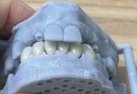 China Full Zirconia Dental Restoration with High Strength Natural Tooth-Like Appearance and Metal-Free Design for sale