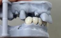 China Full Zirconia Dental Restoration with High Strength Natural Tooth-Like Appearance and Metal-Free Design for sale