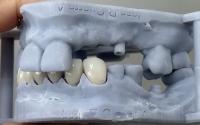 China Full Zirconia Dental Restoration with High Strength Natural Tooth-Like Appearance and Metal-Free Design for sale