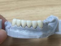 China Full Zirconia Dental Restoration with High Strength Natural Tooth-Like Appearance and Metal-Free Design for sale