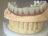 China Implant Bar Supported Full Zirconia Dental Bridge with Full-Contour Zirconia and Natural Tooth Color via Digital CAD/CAM for sale