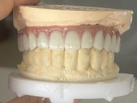 China Implant Bar Supported Full Zirconia Dental Bridge with Full-Contour Zirconia and Natural Tooth Color via Digital CAD/CAM for sale