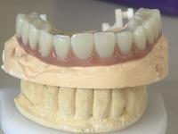 China Implant Bar Supported Full Zirconia Dental Bridge with Full-Contour Zirconia and Natural Tooth Color via Digital CAD/CAM for sale