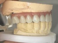 China Implant Bar Supported Full Zirconia Dental Bridge with Full-Contour Zirconia and Natural Tooth Color via Digital CAD/CAM for sale