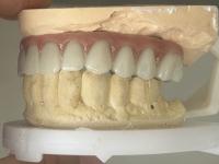 China Implant Bar Supported Full Zirconia Dental Bridge with Full-Contour Zirconia and Natural Tooth Color via Digital CAD/CAM for sale