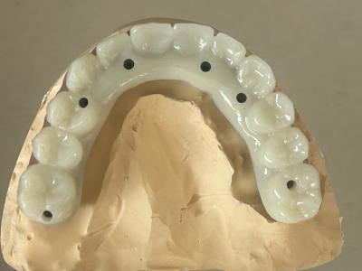 China Implant Bar Supported Full Zirconia Dental Bridge with Full-Contour Zirconia and Natural Tooth Color via Digital CAD/CAM for sale