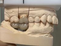 China Full Zirconia Implant Crown with High Strength and Wear Resistance Natural Tooth-Like Appearance Using Digital CAD/CAM Technology for sale