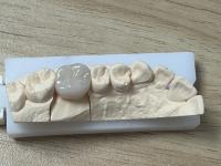 China Full Zirconia Implant Crown with High Strength and Wear Resistance Natural Tooth-Like Appearance Using Digital CAD/CAM Technology for sale