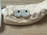 China Full Zirconia Implant Crown with High Strength and Wear Resistance Natural Tooth-Like Appearance Using Digital CAD/CAM Technology for sale