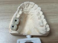 China Full Zirconia Implant Crown with High Strength and Wear Resistance Natural Tooth-Like Appearance Using Digital CAD/CAM Technology for sale