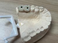 China Full Zirconia Implant Crown with High Strength and Wear Resistance Natural Tooth-Like Appearance Using Digital CAD/CAM Technology for sale