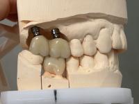 China Full Zirconia Implant Crown with High Strength and Wear Resistance Natural Tooth-Like Appearance Using Digital CAD/CAM Technology for sale