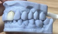 China Custom All-Zirconia Crown with Zirconia Post and Core for Metal-Free Natural Appearance and Precise Fit for sale