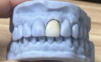 China Custom All-Zirconia Crown with Zirconia Post and Core for Metal-Free Natural Appearance and Precise Fit for sale