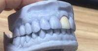 China Custom All-Zirconia Crown with Zirconia Post and Core for Metal-Free Natural Appearance and Precise Fit for sale