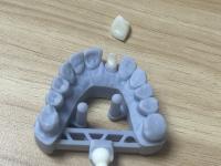 China Custom All-Zirconia Crown with Zirconia Post and Core for Metal-Free Natural Appearance and Precise Fit for sale