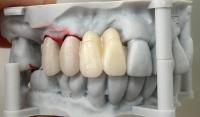 China Customized Full Zirconia Dental Crowns with CAD/CAM Digital Design for High Strength and Durability for sale