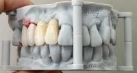 China Customized Full Zirconia Dental Crowns with CAD/CAM Digital Design for High Strength and Durability for sale