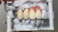 China Customized Full Zirconia Dental Crowns with CAD/CAM Digital Design for High Strength and Durability for sale