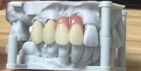 China Customized Full Zirconia Dental Crowns with CAD/CAM Digital Design for High Strength and Durability for sale