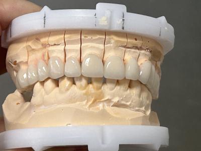 China Custom Monolithic Zirconia Dental Bridge with Digital Design and CAD/CAM Milling for Dental Professionals for sale