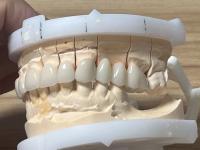 China Custom Monolithic Zirconia Dental Bridge with Digital Design and CAD/CAM Milling for Dental Professionals for sale