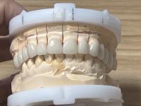China Custom Monolithic Zirconia Dental Bridge with Digital Design and CAD/CAM Milling for Dental Professionals for sale