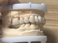 China Custom Monolithic Zirconia Dental Bridge with Digital Design and CAD/CAM Milling for Dental Professionals for sale