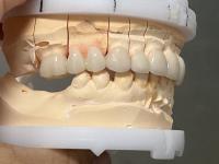 China Custom Monolithic Zirconia Dental Bridge with Digital Design and CAD/CAM Milling for Dental Professionals for sale