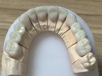 China Custom Monolithic Zirconia Dental Bridge with Digital Design and CAD/CAM Milling for Dental Professionals for sale