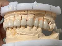 China Custom Monolithic Zirconia Dental Bridge with Digital Design and CAD/CAM Milling for Dental Professionals for sale