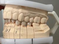 China Custom Full Zirconia Dental Bridge with Digital CAD/CAM Milling and Multiple Tooth Shades for sale