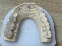 China Custom Full Zirconia Dental Bridge with Digital CAD/CAM Milling and Monolithic Zirconia Structure in Multiple Tooth Shades for sale