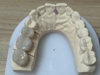 China Custom Full Zirconia Dental Bridge with Digital CAD/CAM Milling and Monolithic Zirconia Structure in Multiple Tooth Shades for sale