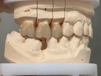 China Custom Full Zirconia Dental Bridge with Digital CAD/CAM Milling and Monolithic Zirconia Structure in Multiple Tooth Shades for sale