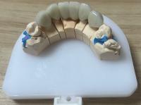 China Cobalt-Chromium Alloy Porcelain-Fused-to-Metal Dental Bridge with Natural Tooth-Colored Porcelain Customized to Patient-Specific Dental Requirements for sale
