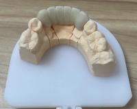 China Cobalt-Chromium Alloy Porcelain-Fused-to-Metal Dental Bridge with Natural Tooth-Colored Porcelain Customized to Patient-Specific Dental Requirements for sale