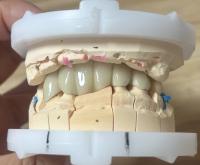 China Cobalt-Chromium Alloy Porcelain-Fused-to-Metal Dental Bridge with Natural Tooth-Colored Porcelain Customized to Patient-Specific Dental Requirements for sale