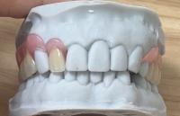 China Lightweight Comfortable Discreet Appearance Flexible Removable Denture and Invisible Removable Denture Base for sale